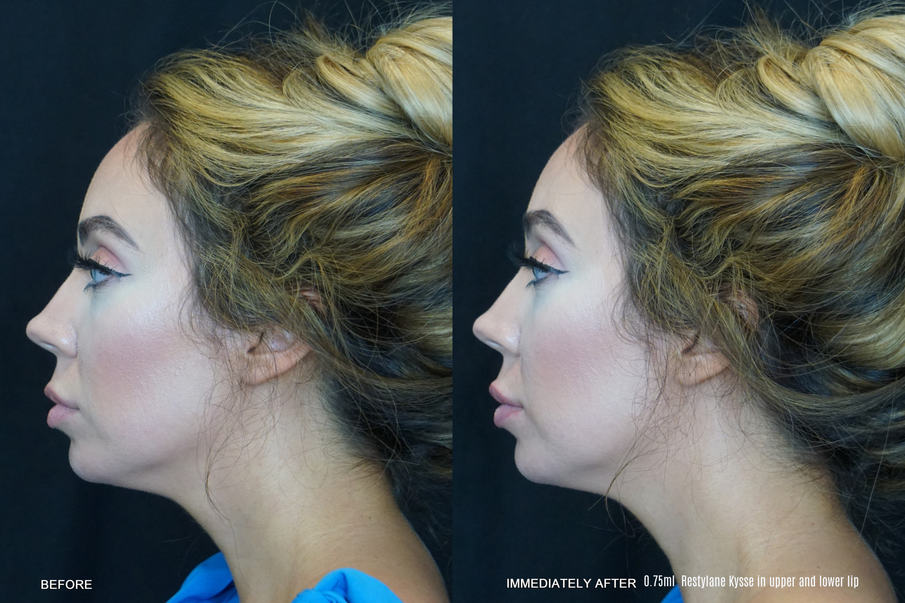 Restylane Kysse Before And After Tararrized